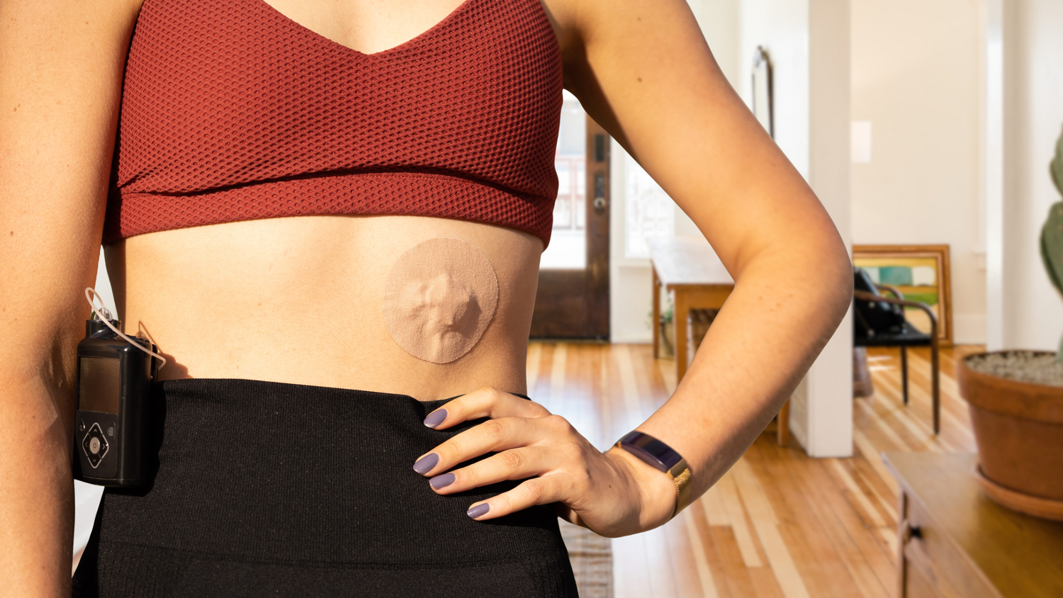 Preventing CGM Patch Skin Burn - What Actually Works